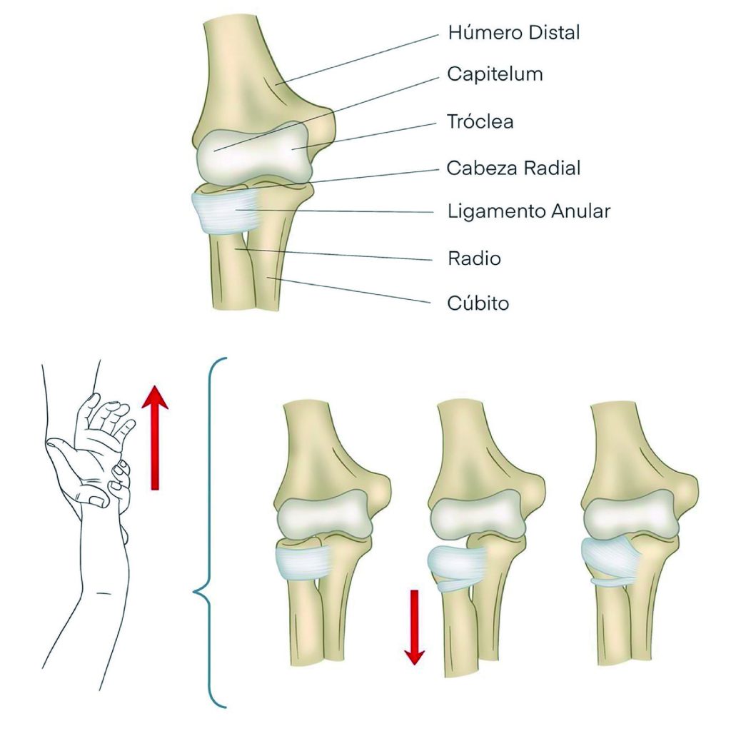 Codo de niñera - Dr. Barragán Pediatra
